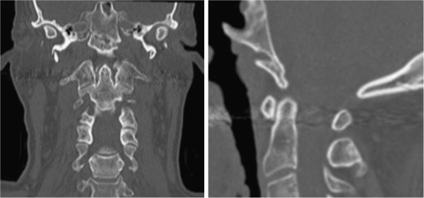 Management of an extended clivus fracture: a case report | BMC Research ...
