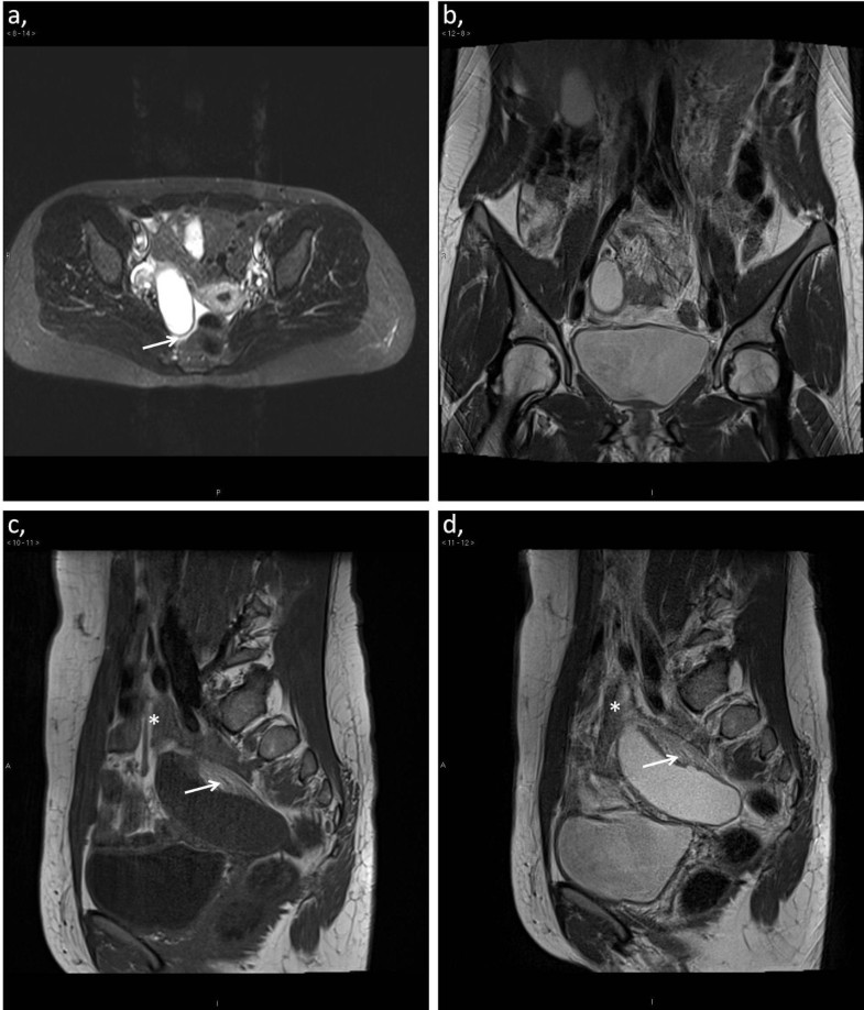 Preoperative assessment and treatment of appendiceal mucocele ...