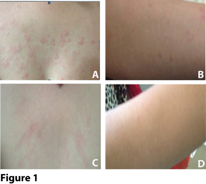 Acute urticaria as a side effect of the Mirena® (levonorgestrel ...