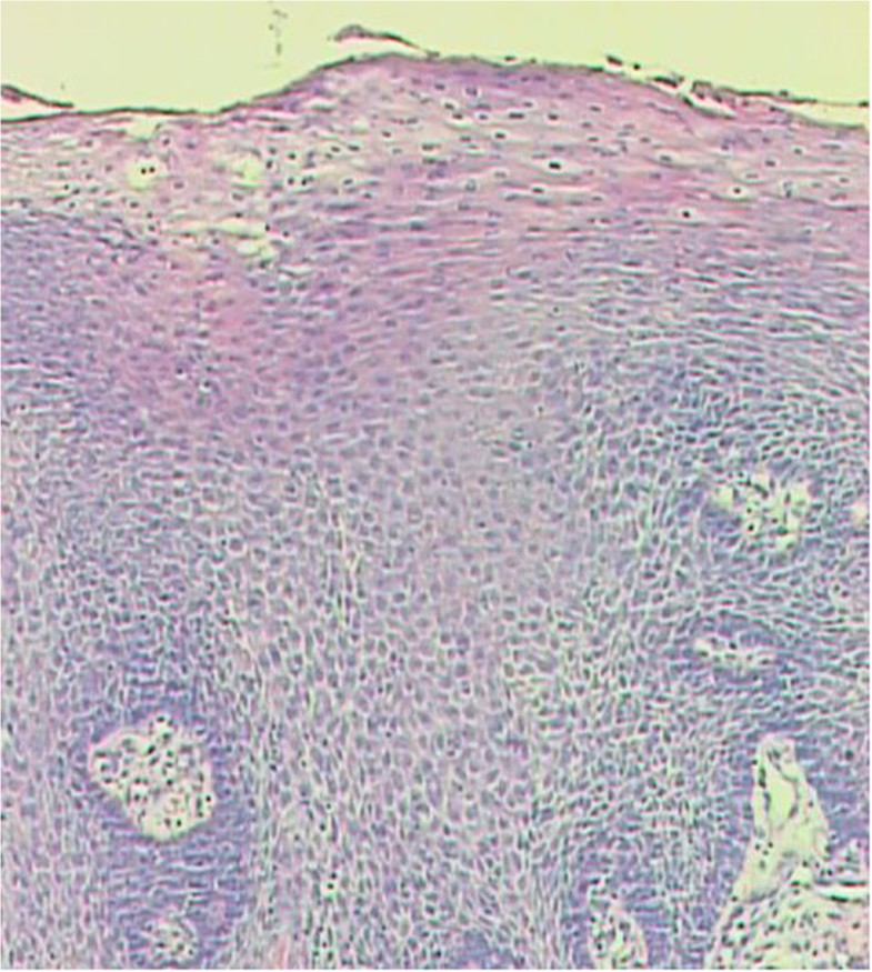 Condyloma acuminata in the tongue and palate of a sexually abused child ...