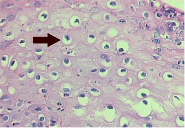 Condyloma acuminata in the tongue and palate of a sexually abused child ...