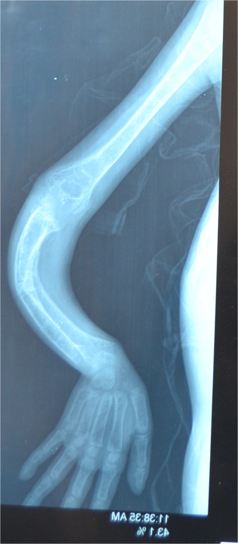 Severe rickets in a young girl caused by celiac disease: the tragedy of ...