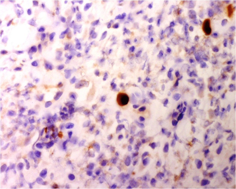 Cytomegalovirus proctitis mimicking rectal cancer in an immunocompetent ...