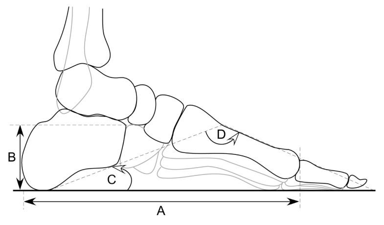 Plantar calcaneal spurs in older people: longitudinal traction or ...