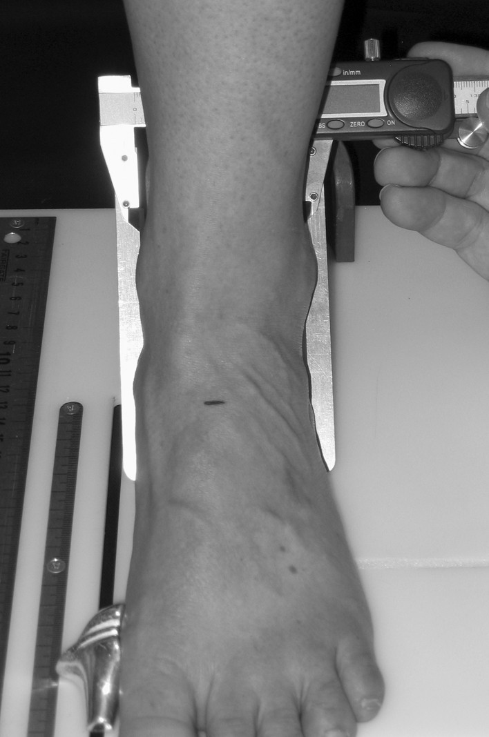 Can foot anthropometric measurements predict dynamic plantar surface ...