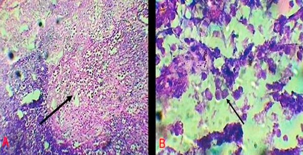 Acute fulminant necrotizing amoebic colitis: a rare and fatal ...