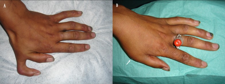 Left hand polydactyly: a case report | Cases Journal | Full Text