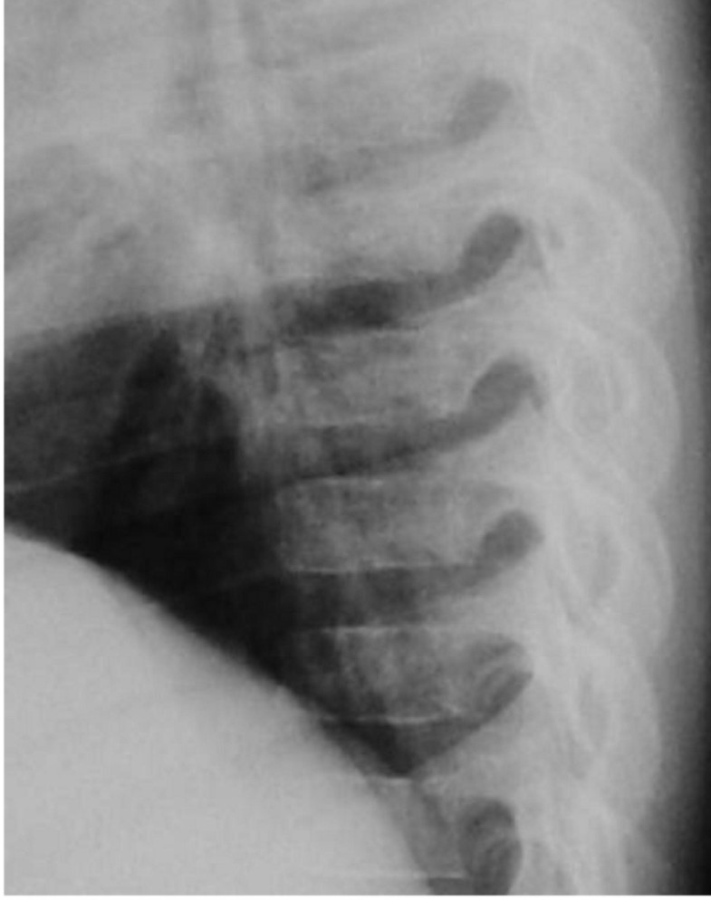 Arthrogryposis multiplex congenital in a child manifesting phenotypic ...