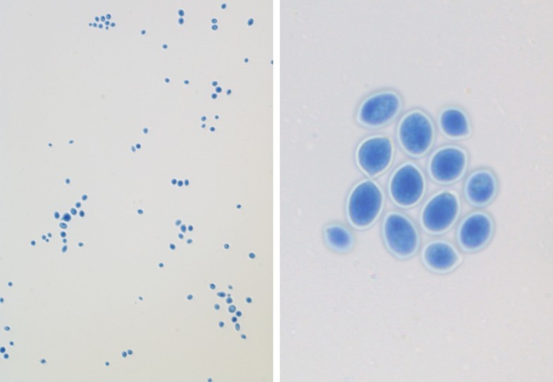 Disseminated cryptococcosis with meningitis, peritonitis, and ...