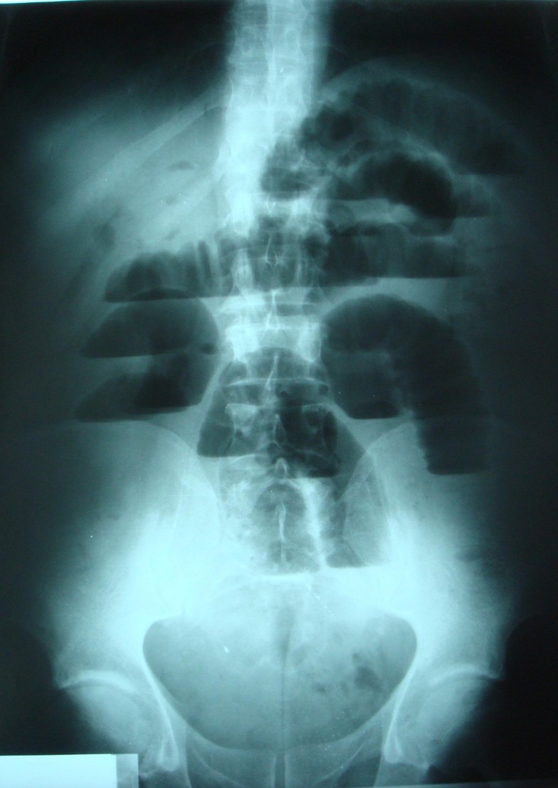 Uncommon cause of small bowel obstruction - gallstone ileus: a case ...