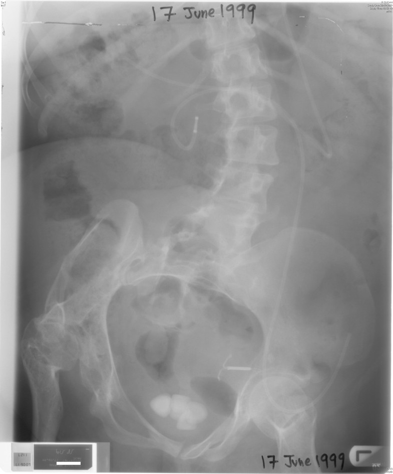 Complications of Benchekroun vesicostomy in a spina bifida patient ...