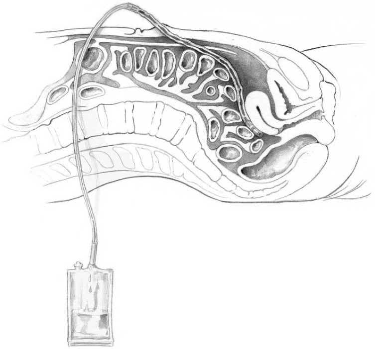 Diagnostic peritoneal lavage: a review of indications, technique, and ...