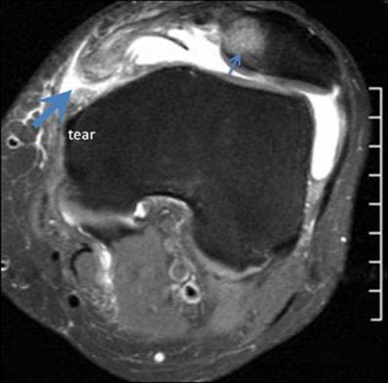 Medial patellofemoral ligament injury patterns and associated pathology ...