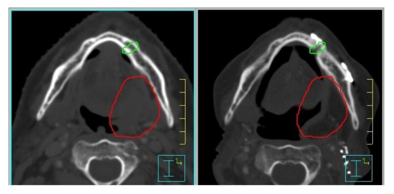 Medial Mandibulotomies: Is there sufficient space in the midline to ...