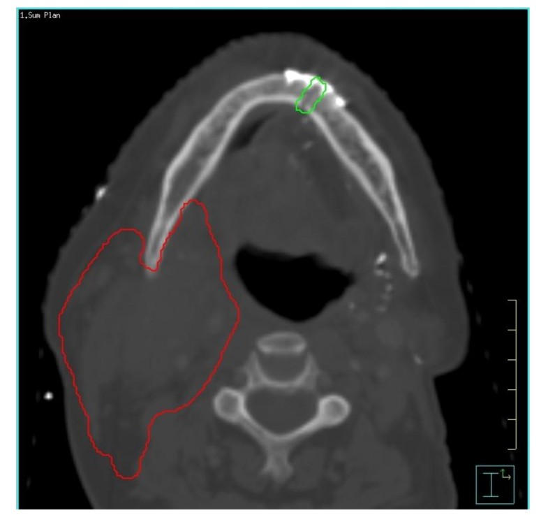 Medial Mandibulotomies: Is there sufficient space in the midline to ...