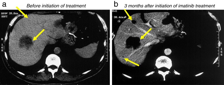Management of imatinib-associated skin rash in a patient with ...