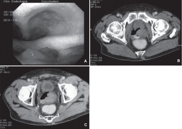 Conservative management of rectal perforation after nerve sparing ...