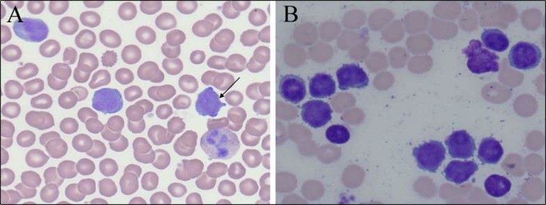 “T-cell prolymphocytic leukemia (T-PLL), a heterogeneous disease ...
