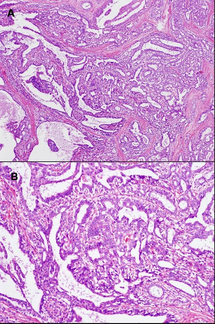 Adenomyoepithelial adenosis associated with breast cancer: a case ...