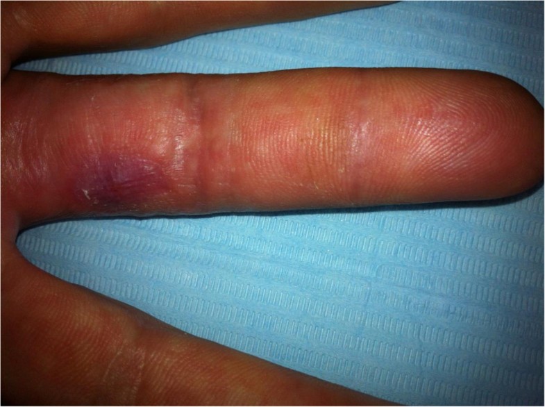 Third degree formic acid chemical burn in the treatment of a hand wart ...