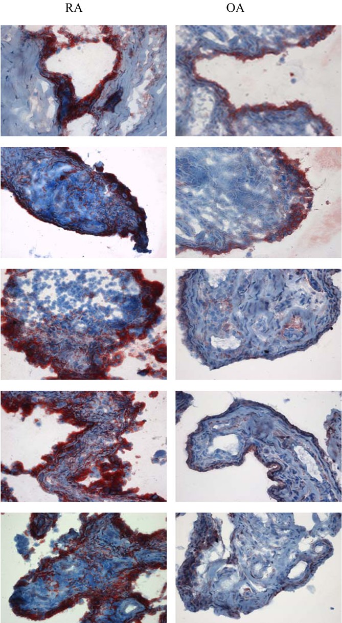Fibroblast activation protein is expressed by rheumatoid myofibroblast ...