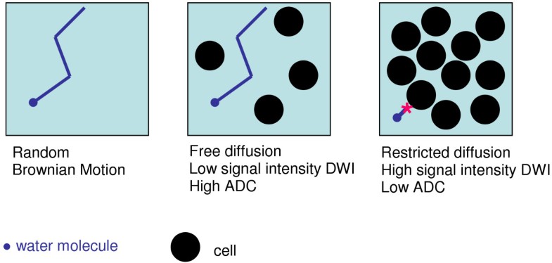 Functional magnetic resonance: biomarkers of response in breast cancer ...