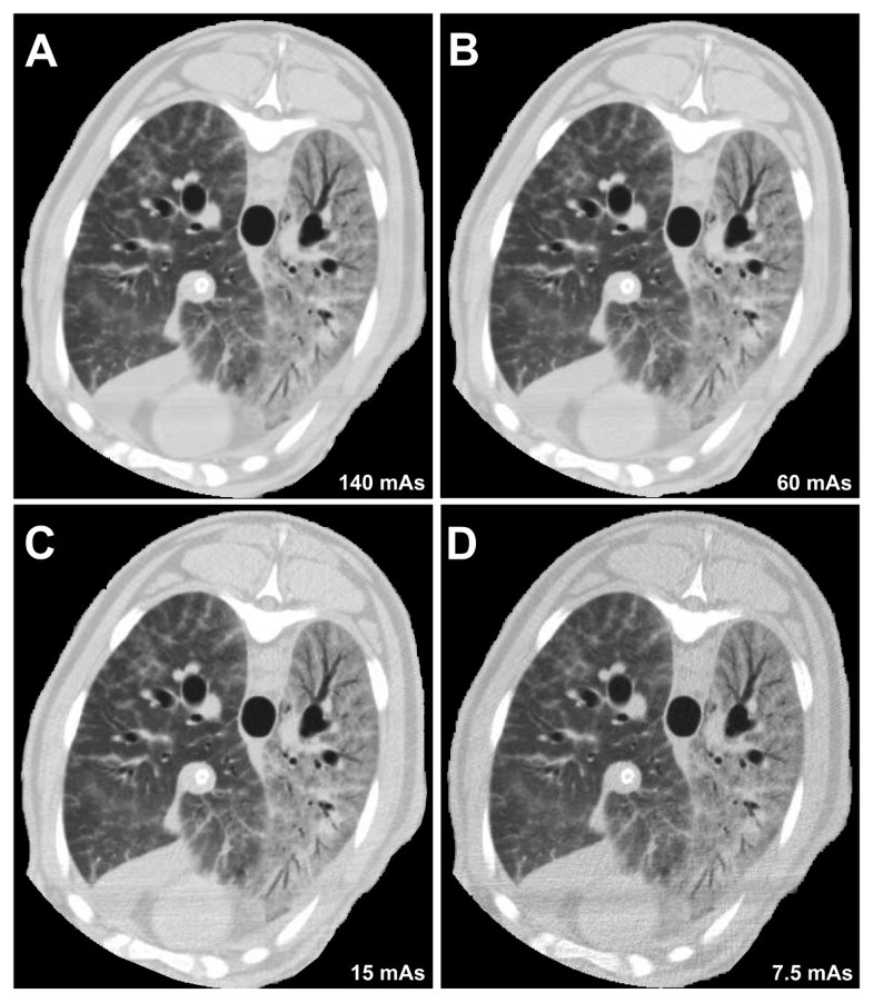 Low-dose CT for quantitative analysis in acute respiratory distress ...