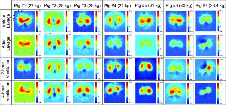 Automatic protective ventilation using the ARDSNet protocol with the ...