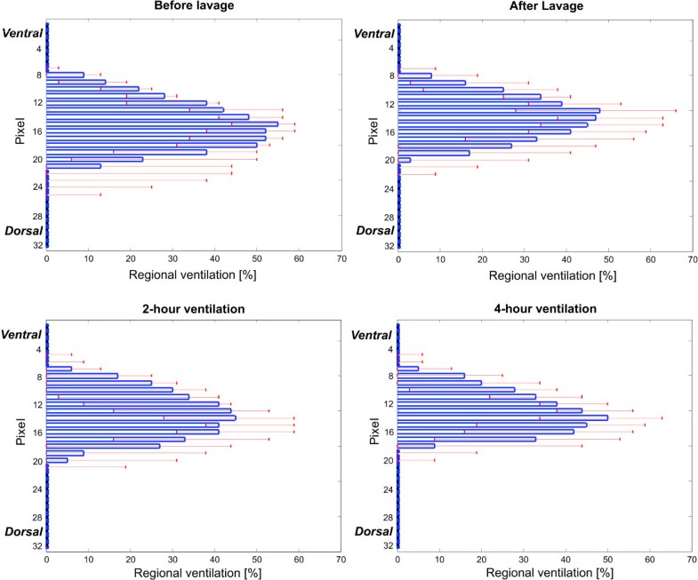 Automatic protective ventilation using the ARDSNet protocol with the ...