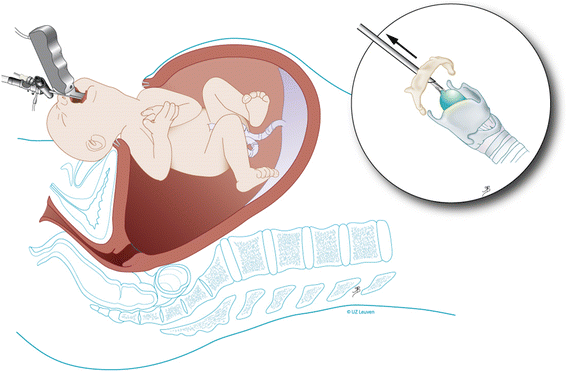 Fetoscopic endoluminal tracheal occlusion and reestablishment of fetal ...