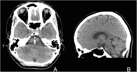 The hyperdense basilar artery sign: a case of locked-in syndrome ...