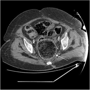 Stercoral colitis mimicking appendicitis | International Journal of ...