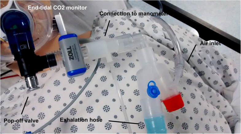 A pilot study of improvised CPAP (iCPAP) via face mask for the ...