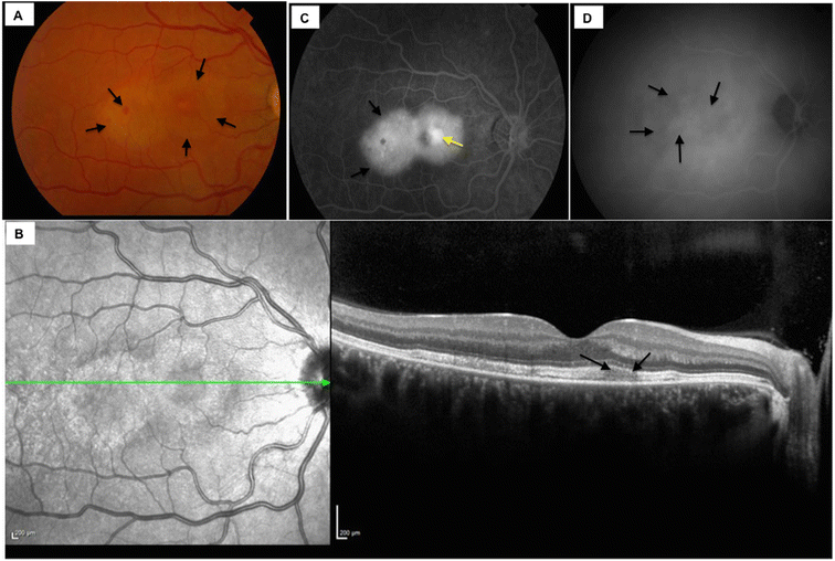 Unilateral acute maculopathy associated with adult onset hand, foot and ...