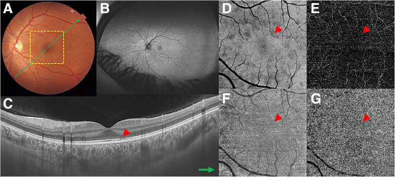 Swept-source OCT in patients with multiple evanescent white dot ...