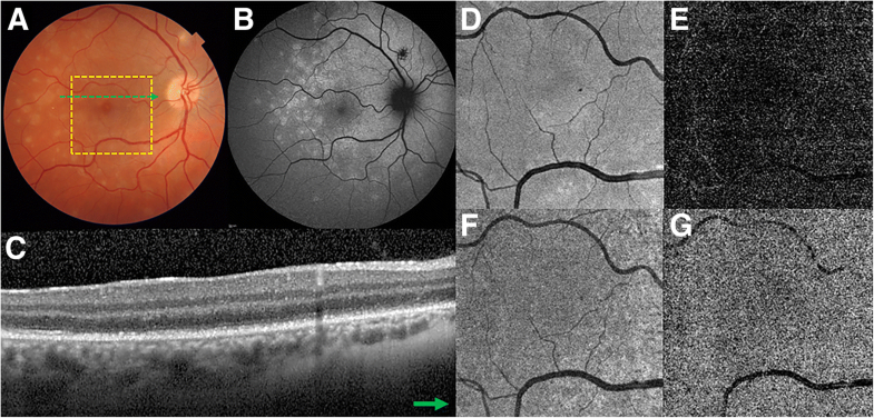 Swept-source OCT in patients with multiple evanescent white dot ...