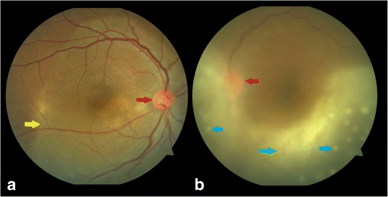 Syphilitic uveitis misdiagnosed as viral retinitis—a misleading history ...