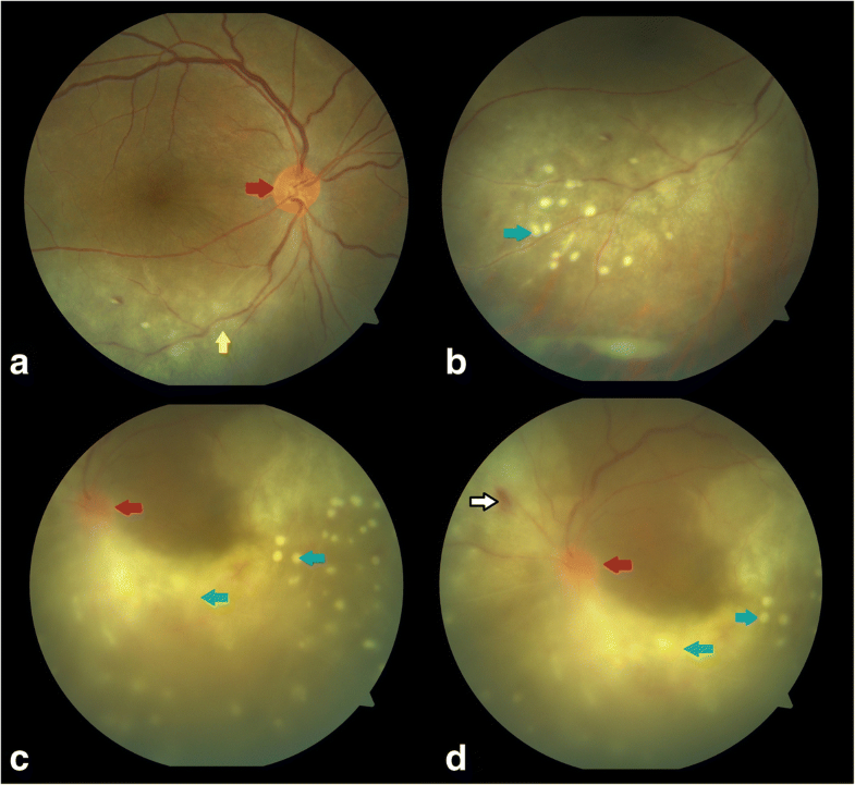Syphilitic uveitis misdiagnosed as viral retinitis—a misleading history ...