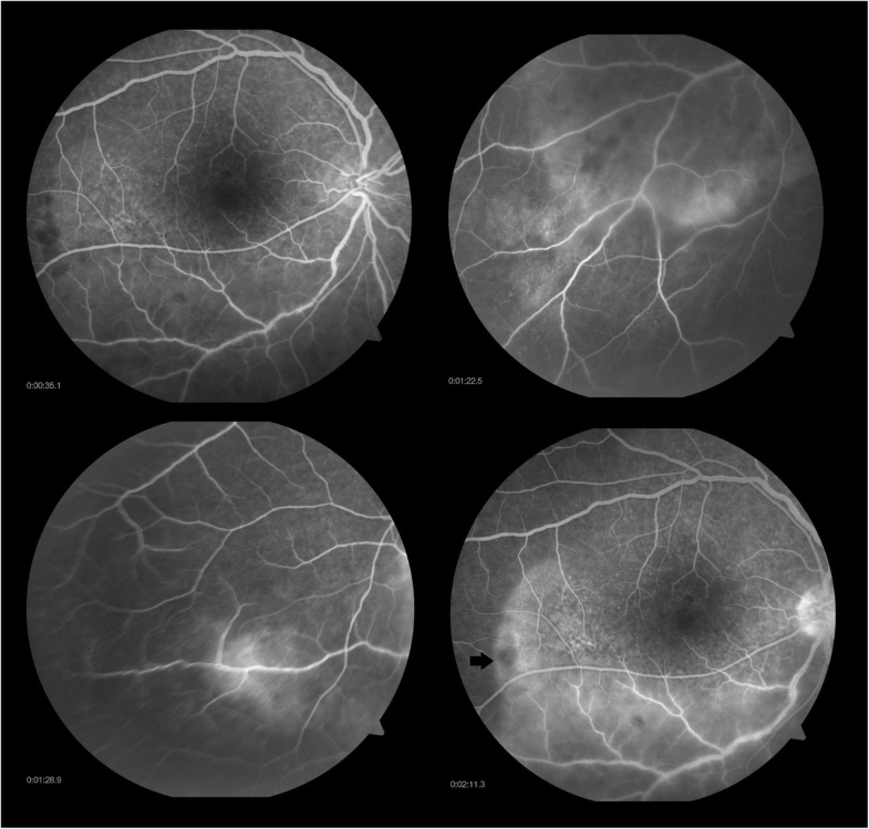 Syphilitic uveitis misdiagnosed as viral retinitis—a misleading history ...