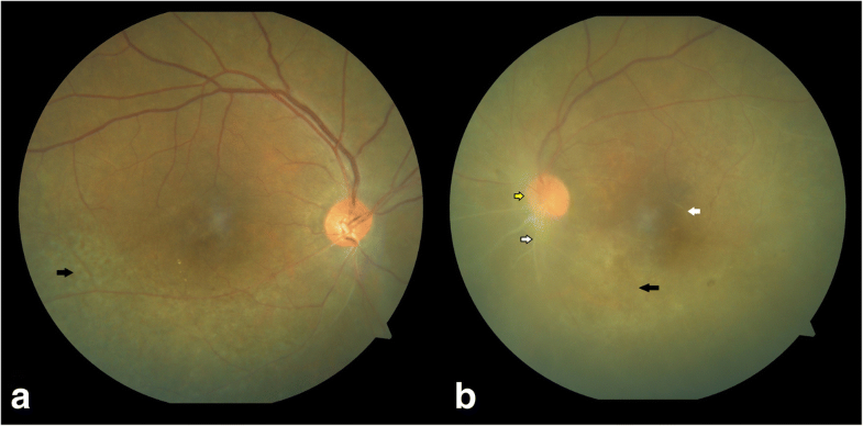Syphilitic uveitis misdiagnosed as viral retinitis—a misleading history ...