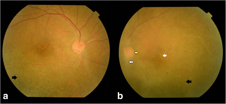 Syphilitic uveitis misdiagnosed as viral retinitis—a misleading history ...