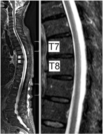 Acute transient spinal paralysis and cardiac symptoms following an ...
