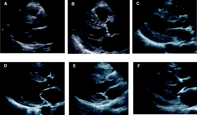 Differentiation of infiltrative cardiomyopathy from hypertrophic ...
