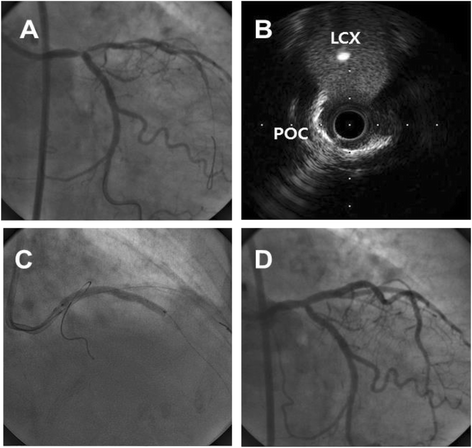Practical based approach to left main bifurcation stenting | BMC Cardiovascular Disorders | Full ...