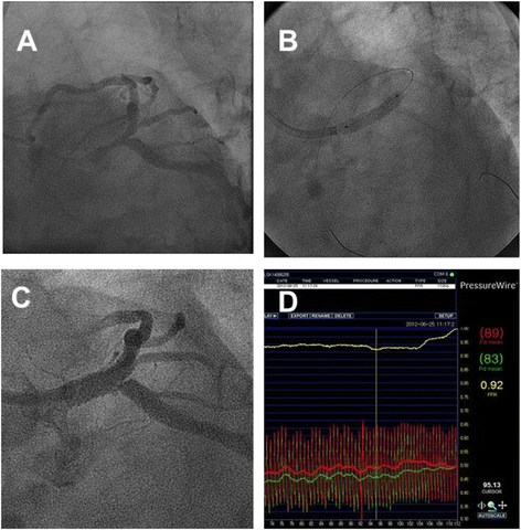 Practical based approach to left main bifurcation stenting | BMC Cardiovascular Disorders | Full ...