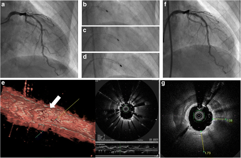 Optical coherence tomography findings after longitudinal ablation for ...