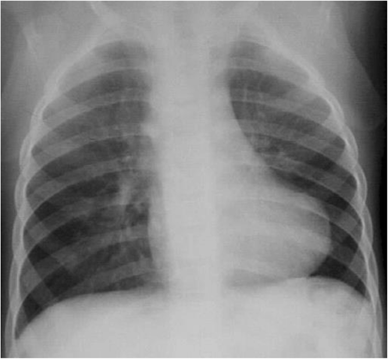 Cardiovascular imaging approach in pre and postoperative tetralogy of ...