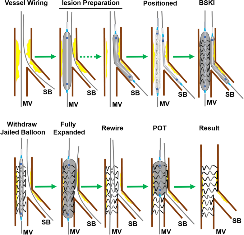 Modified balloon-stent kissing technique avoid side-branch compromise ...