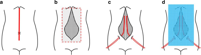 Decompressive laparotomy for abdominal compartment syndrome resulting ...