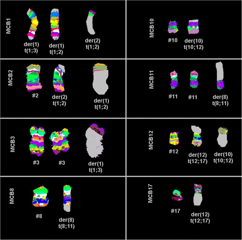 A new adult AML case with an extremely complex karyotype, remission and ...